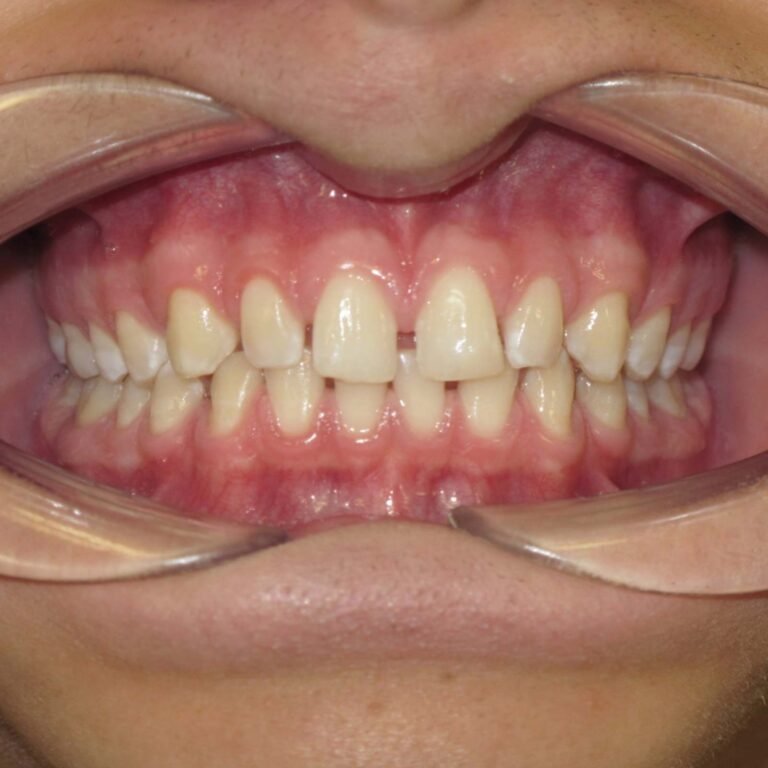 Teeth Spacing - Orthodontist Ottawa ON | Centrepointe Orthodontics