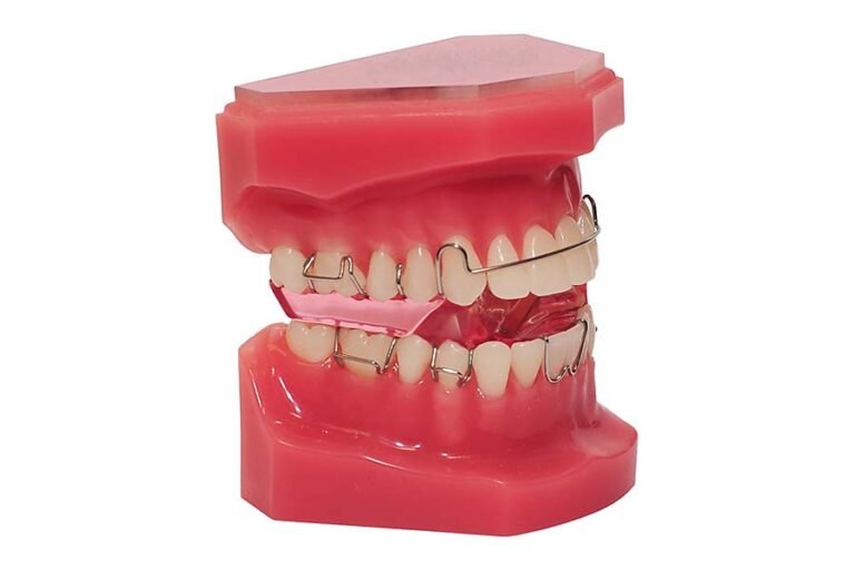 Twin Block - Orthodontist Ottawa ON | Centrepointe Orthodontics